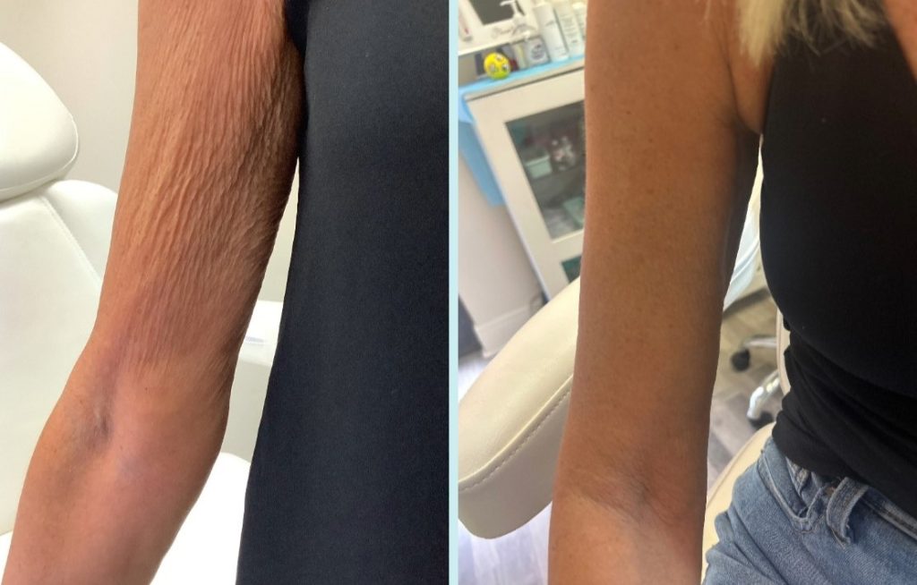 The Benefits of Radiofrequency Treatment for Skin Rejuvenation - Kenzi ...